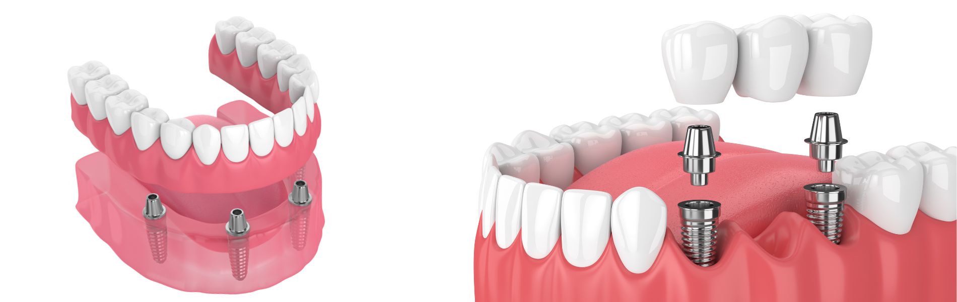 Looking into Dentures on Implants (Snap-In Dentures) in Port Orange ...